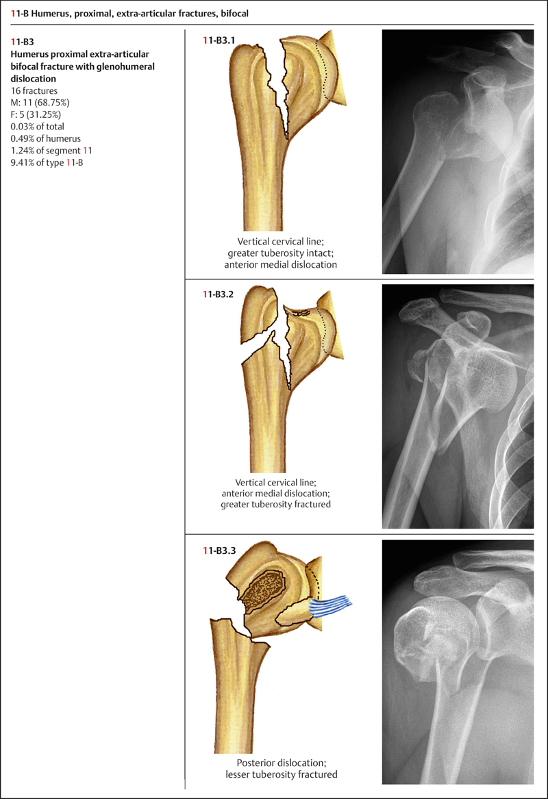 Type Of Bone Fractures