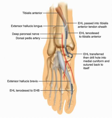 Reconstruction Of Tibialis Anterior Tendon Ruptures Musculoskeletal Key Reconstruction Of Tibialis Anterior Tendon Ruptures Musculoskeletal Key