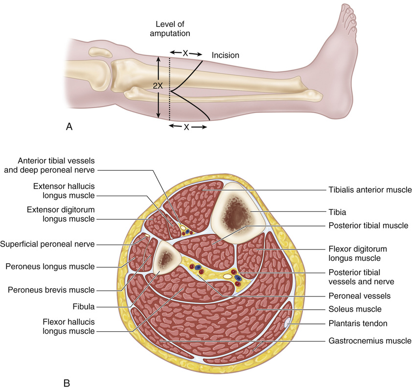57 Below Knee Amputation Musculoskeletal Key 57 Below Knee Amputation Musculoskeletal Key