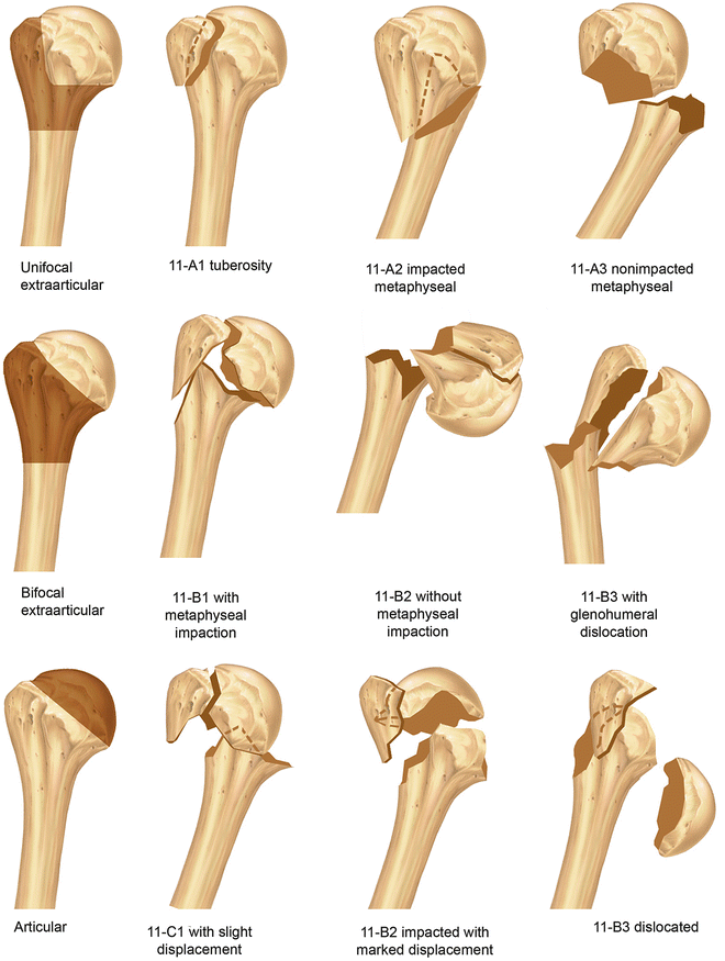 Neer Classification Of Humeral Head Fractures At Patrick Jefferson Blog