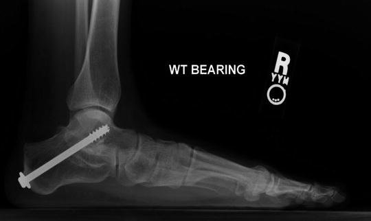 Flatfoot Surgery Musculoskeletal Key