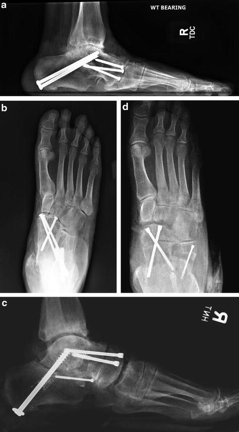 Flatfoot Surgery Musculoskeletal Key
