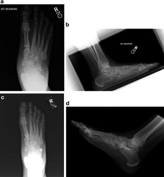 Flatfoot Surgery Musculoskeletal Key