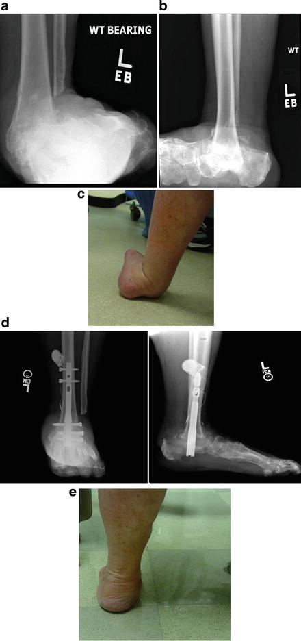 Flatfoot Surgery Musculoskeletal Key