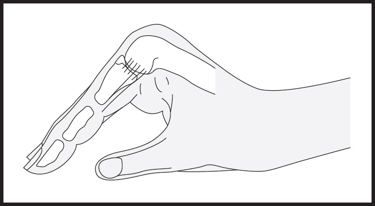WRIST AND HAND | Musculoskeletal Key