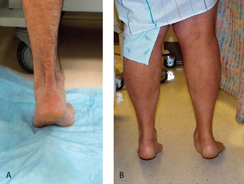 Flatfoot Surgery Musculoskeletal Key