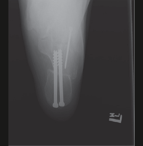 Flatfoot Surgery Musculoskeletal Key