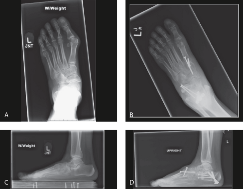 Flatfoot Surgery Musculoskeletal Key