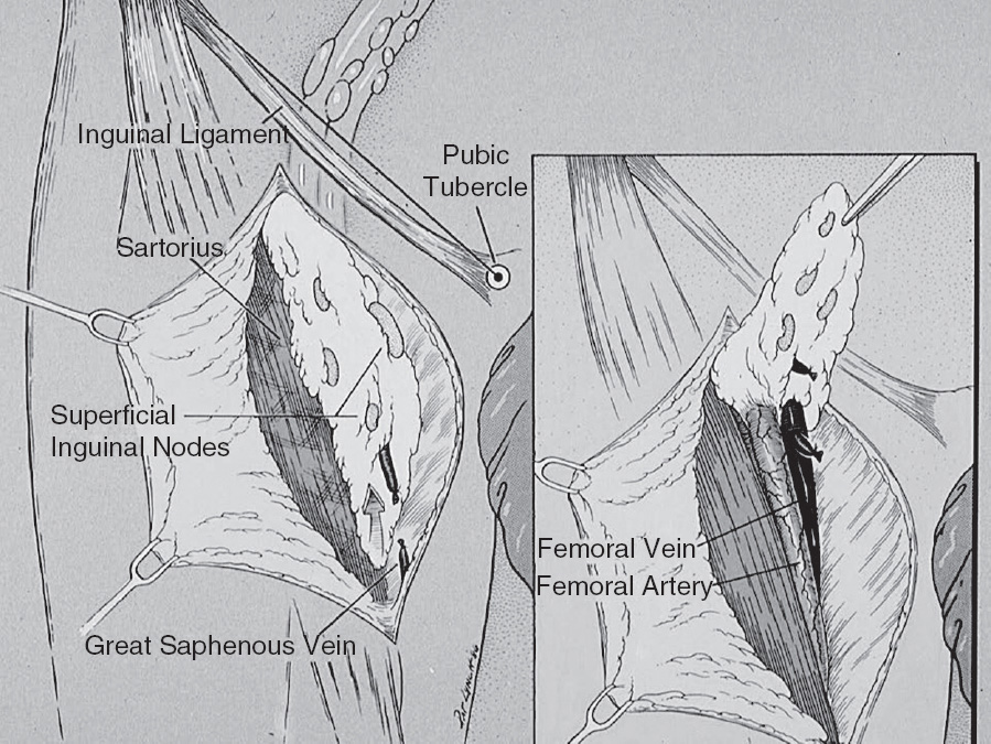 Lymph Node Dissection Musculoskeletal Key
