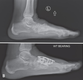 Arthrodesis Of The Tarsometatarsal Joint Musculoskeletal Key