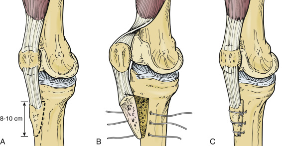Tibial Tubercle Osteotomy Musculoskeletal Key