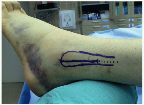 Ankle Fractures Musculoskeletal Key