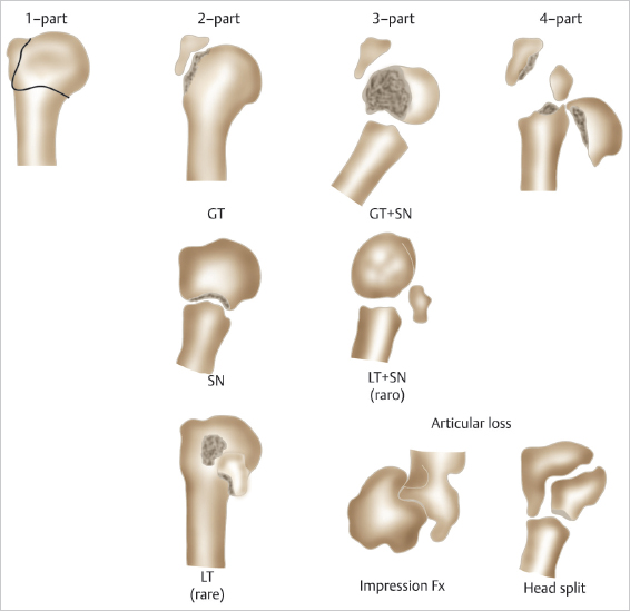 Neer Classification Of Humeral Head Fractures At Patrick Jefferson Blog