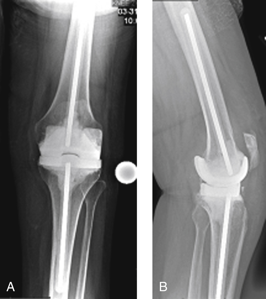 What Are Knee Spacers At Annie Ettinger Blog What Are Knee Spacers At Annie Ettinger Blog